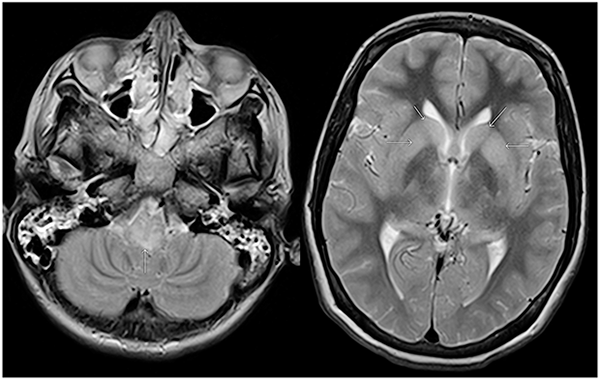 Lyssin (リシン）依存と苦しみのレメディ
